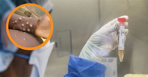 Secretaría de Salud de Bogotá despliega plan de acción para prevenir y combatir el mpox Infobae