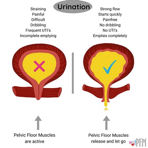 Urge Urinary Incontinence And Overactive Bladder Syndrome