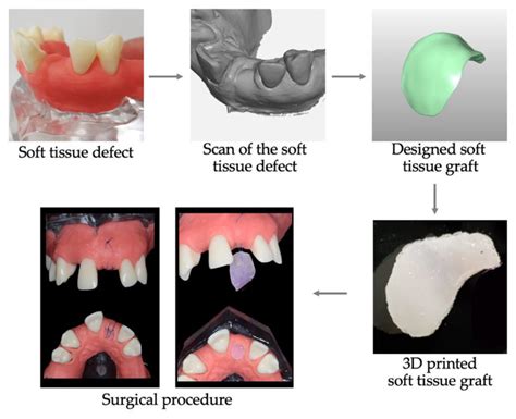Digital Workflow” For Soft Tissue Augmentation The Soft Tissue Defect Download Scientific