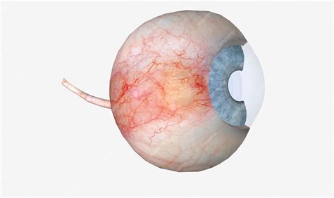 Premium Photo A Pinguecula Is A Common Noncancerous Growth Of The Clear Thin Tissue