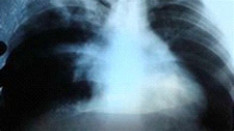 Безплатни прегледи за туберкулоза в сливенската болница Новини бг