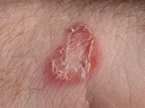 What Causes Red Patches On Your Legs Infoupdate Org