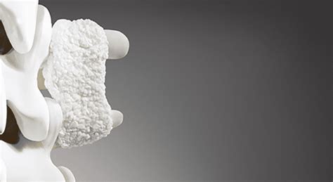 Ossdsign Fully Enrolls Propel Spinal Fusion Registry Orthoworld
