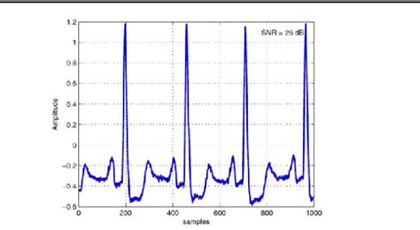 Figure 2 From A Proposed Technique Based On Wavelet Transform For Electrocardiogram Signal