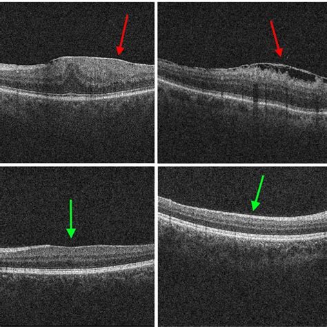 Examples Of Erm Presence And Absence In Oct Scans 1 St Row Erm Download Scientific Diagram