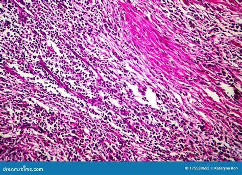 Carcinoma Squamoso Delle Cellule Del Micrografo A Luce Uterina