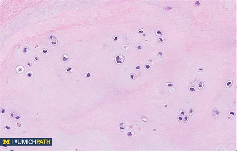 Michigan Pathology On Twitter Multinodular Histology Is In Contrast
