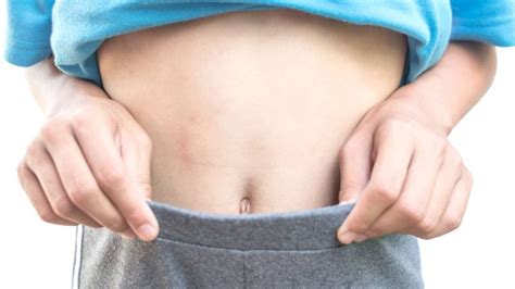 Iae Más De 750 Millones De Personas Están Desnutridas En El Mundo El