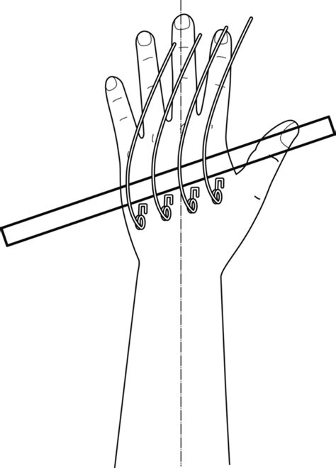 Low Profile Radial Nerve Palsy Orthosis With Radial And 58 Off