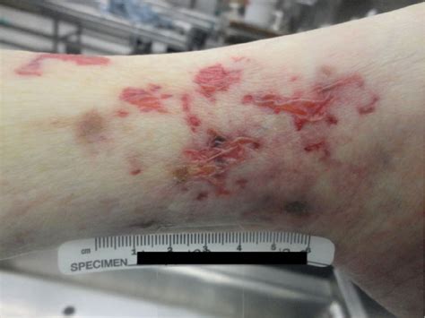 Pasteurella Multocida Human Infection