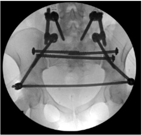 Intra Op Fluoroscopic Image After Application Of Bilateral Triangular Download Scientific