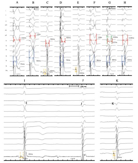 Evaluation Of Electrophysiological Characteristics And Ventricular