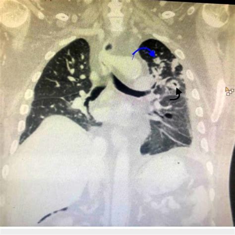 Ct Scan Showing Spiculated Nodule Demostrated By Blue Arrow And Download Scientific Diagram
