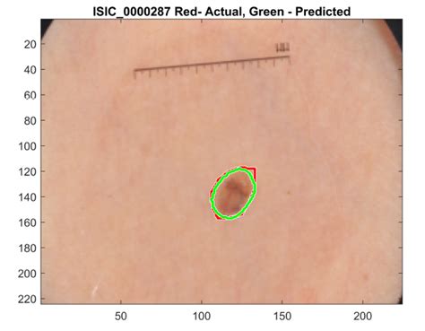Semantic Segmentation For Medical Imaging Artificial Intelligence Matlab Simulink
