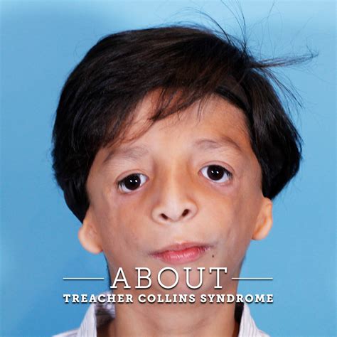Mild Treacher Collins Syndrome