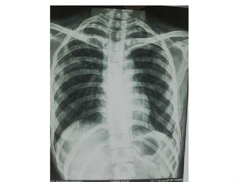Chest X Ray Showing Bilateral Discrete Fine Retico Nodular Densities Download Scientific Diagram