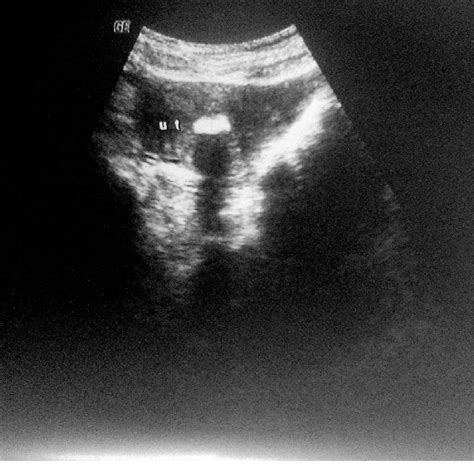 Longitudinal Sagittal USG Section Showing The Uterus And Hyperechoic Download Scientific