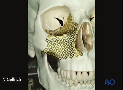 Midface Reconstruction