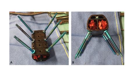 En Bloc Video Assisted Thoracoscopic Vertebrectomy For A Spinal Tumour