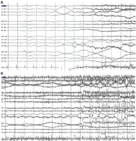 Figure 7 1 From Electroencephalography In Epilepsy Evaluation Semantic Scholar