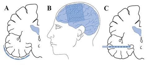 Intracranial Eeg Electrodes A Strip Electrode Targeting The