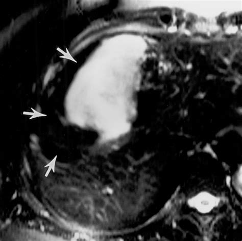 Echinococcus Multilocularis Revisited Ajr