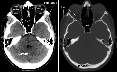 Ct Anatomy Of The Brain
