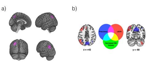 voxel based morphometry results and overlap with intrinsic functional