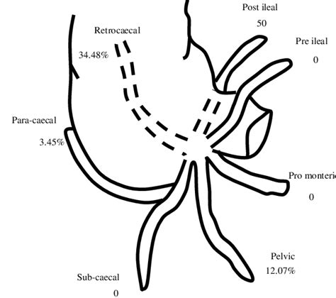 Positions Of The Tip Of The Appendix Download Scientific Diagram