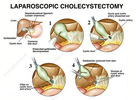Laparoscopic Cholecystectomy Steps Cholecystectomy Open Versus