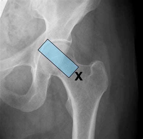 Hip Arthrogram Injection