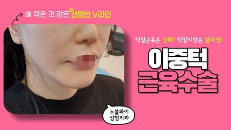 턱살 제거 원한다면 턱밑근육을 교정하는 이중턱근육수술 필요★더보기란 필독★ Youtube