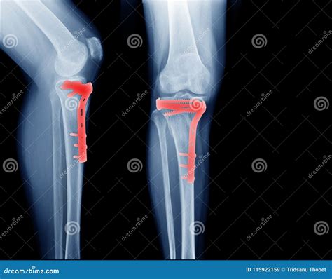 Proximal Tibia Fixation Stock Image Image Of Diagnosis 115922159