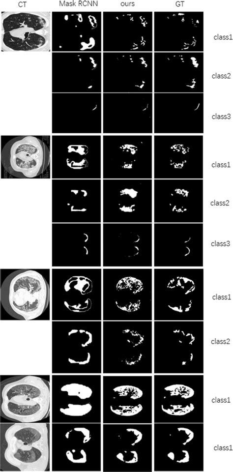 Visual Comparison Of Infection Segmentation In Detail Columns 14 Ct Download Scientific