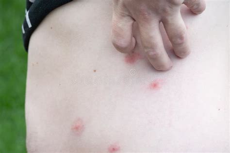 Bites On The Skin Of A Man Stock Image Image Of Virus 303670597