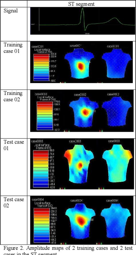 Figure 2 From Body Surface Potential Mapping For Detection Of Myocardial Infarct Sites