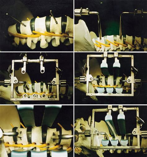Figure 2 From Minimally Invasive Retroperitoneal Approach For Lumbar Corpectomy And Anterior