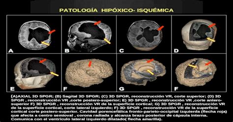 PatologÍa HipÓxico IsquÉmica A Axial 3d Spgr B Sagital 3d Spgr C 3d Spgr