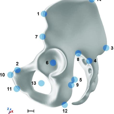 Pelvis With Acetabulum Defect Paprosky Iiia And A Minimal Bounding Download Scientific