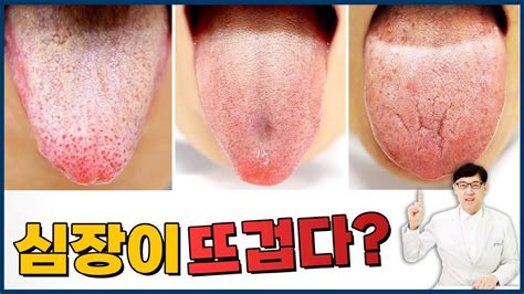 심열증 심장이 뜨거워요 가슴이 두근거리고 불안해요 YouTube