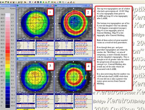 Wilcox Eye Corneal Molding