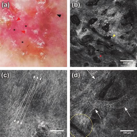 Dermoscopy And Rcm In Superficial Bcc A Dermoscopy Image Of A Download Scientific Diagram