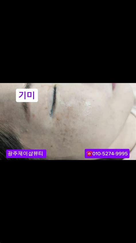 광주피부관리 광주기미관리 광주체형관리 광주웨딩ㅣ제이샵뷰티 흑자제거 또는 검버섯치료 언제 있었냐는듯 깔끔하게 깊이나 크기에