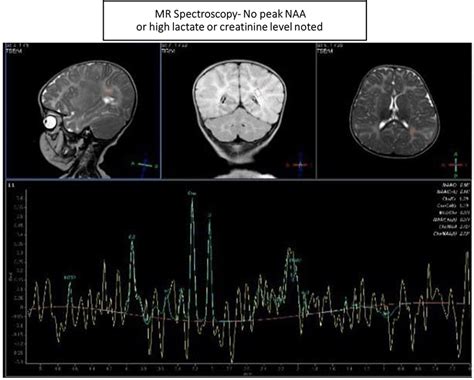 Magnetic Resonance Spectroscopy Showing No Peak N Acetyl Aspartate Or Download Scientific