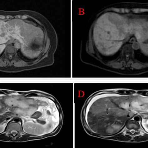 Comparison Of MRI Before And After RT Of Patients With Diffuse Liver Download Scientific