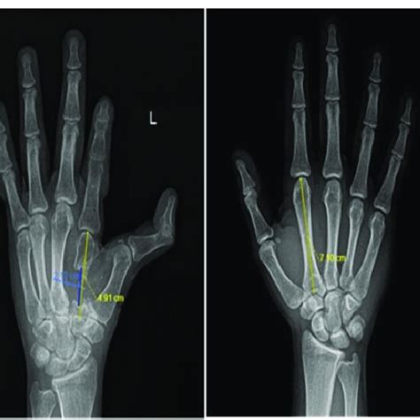 Anterior View Of The Left Hand Metacarpal External Fixator Download Scientific Diagram