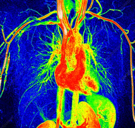 Heart And Torso Blood Vessels Mri Angiogram Stock Image C Science Photo Library