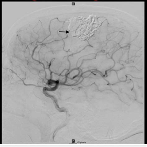 Follow Up Six Years Later Revealing Complete Regression Of AVM With Download Scientific Diagram