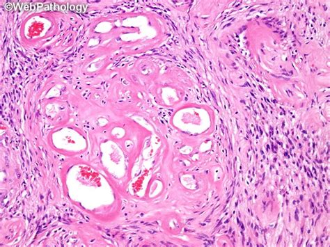Schwannoma Hyalinized Vessels