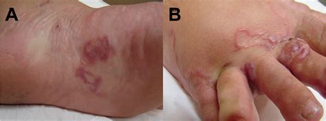 Hookworm Infection Symptoms Diagnosis And Hookworm Treatment In Humans